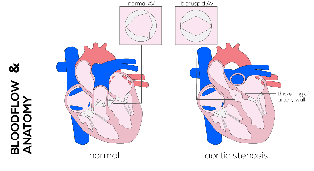Congenital Aortic Stenosis