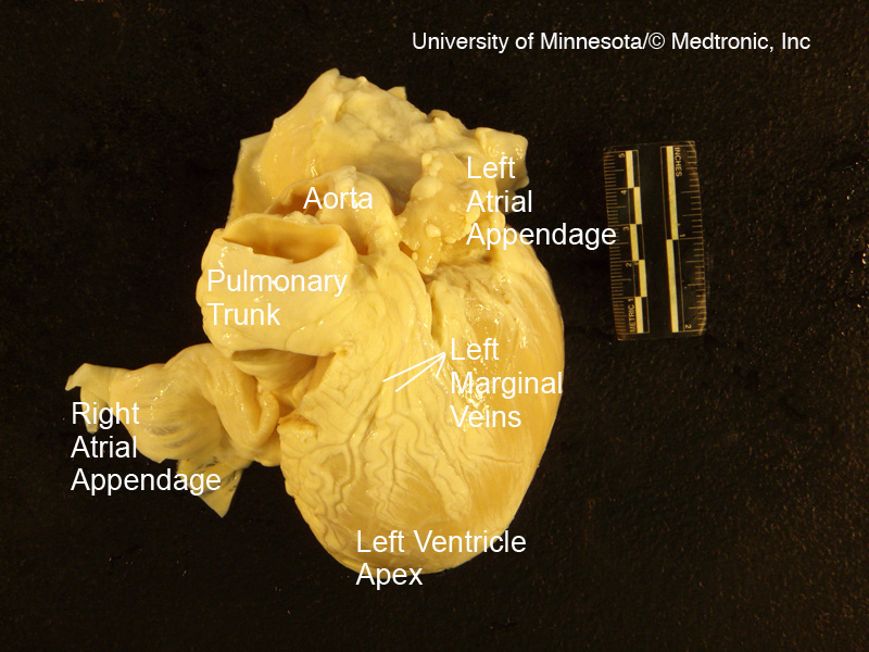 Pulmonary Trunk | Atlas of Human Cardiac Anatomy