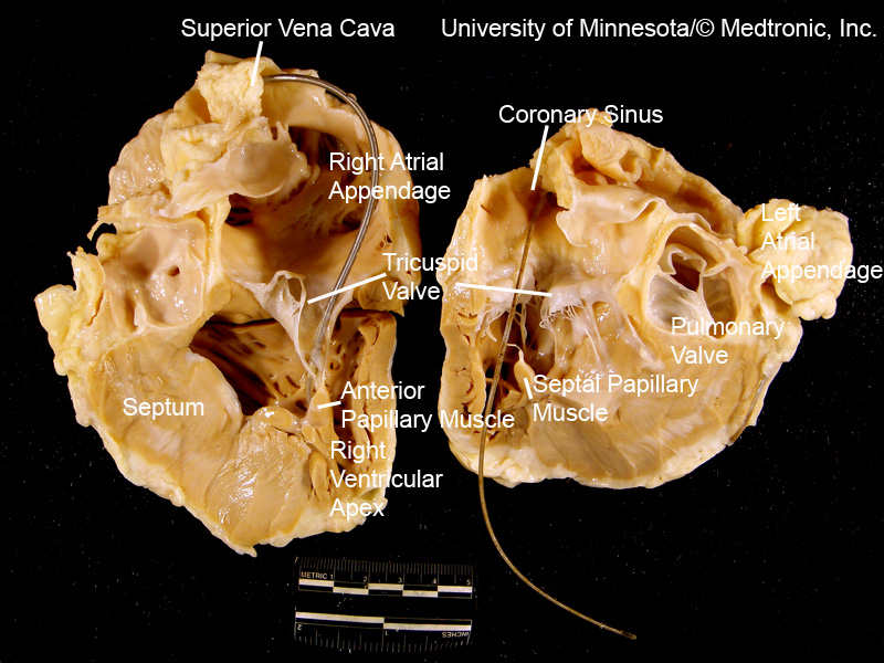 Pulmonary Trunk | Atlas of Human Cardiac Anatomy