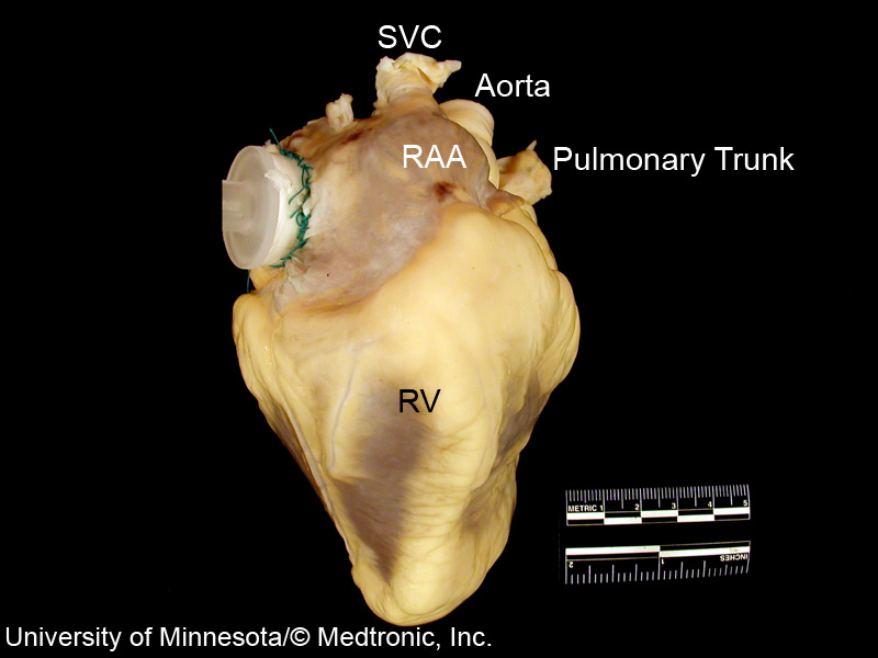 Pulmonary Trunk | Atlas of Human Cardiac Anatomy